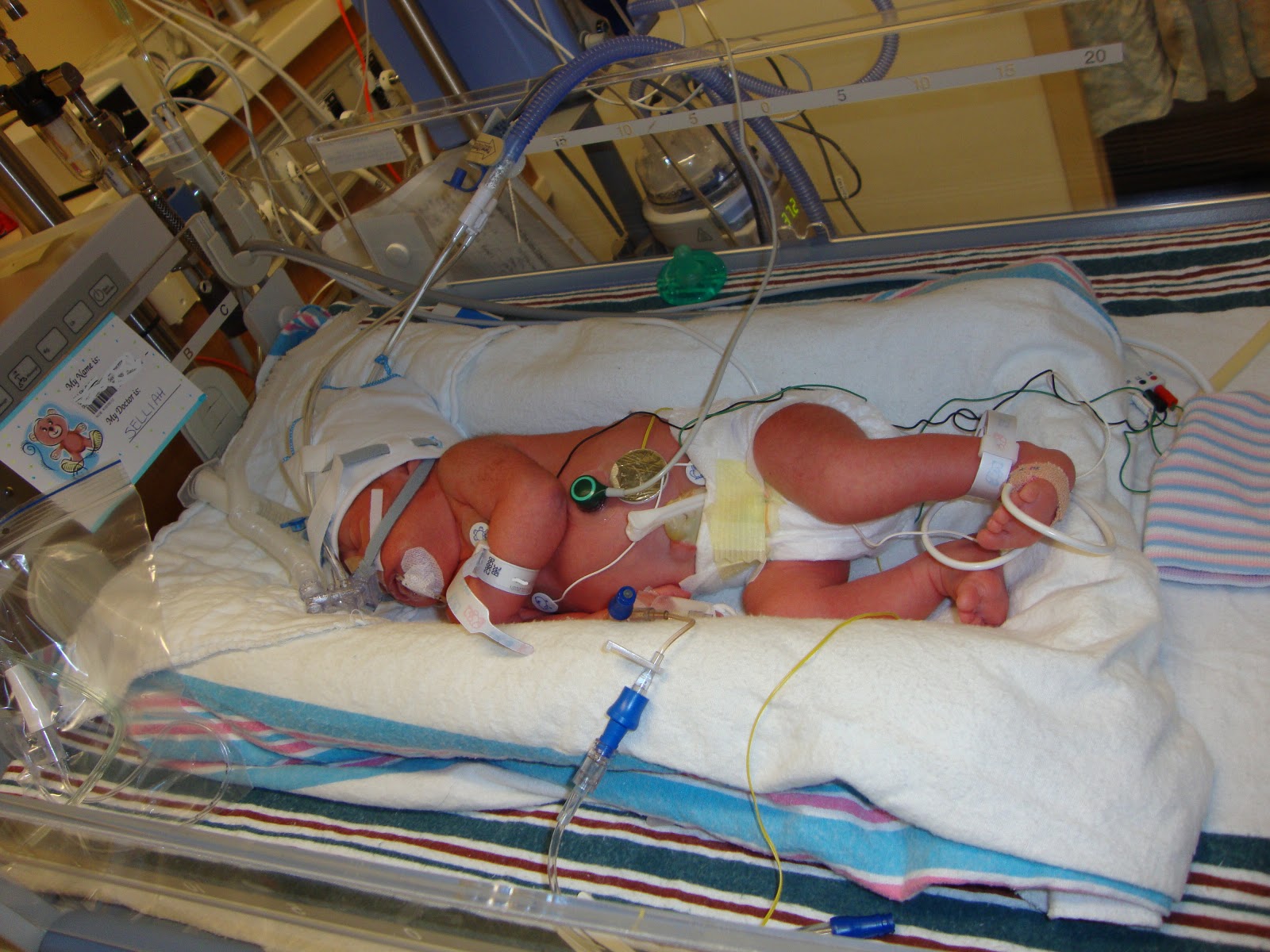Breastfeeding a Preemie - One Mom's Journey - SavvyMom